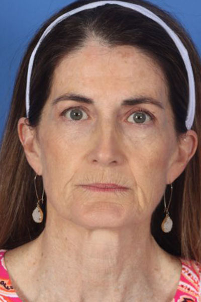 Facelift and Neck Lift Case 5229 - Dr. Guy