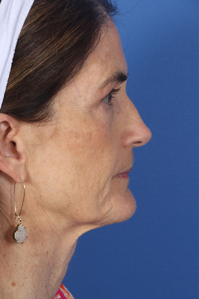 Facelift and Neck Lift Case 5229 - Dr. Guy