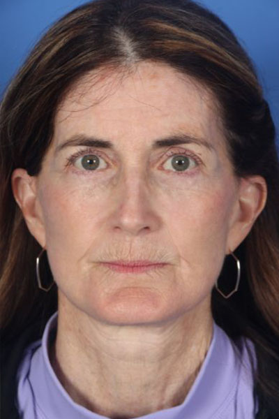Facelift and Neck Lift Case 5229 - Dr. Guy
